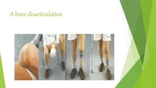 Amputation.pptx | Death, Injury, or Military Conflict | Sensitive Topics