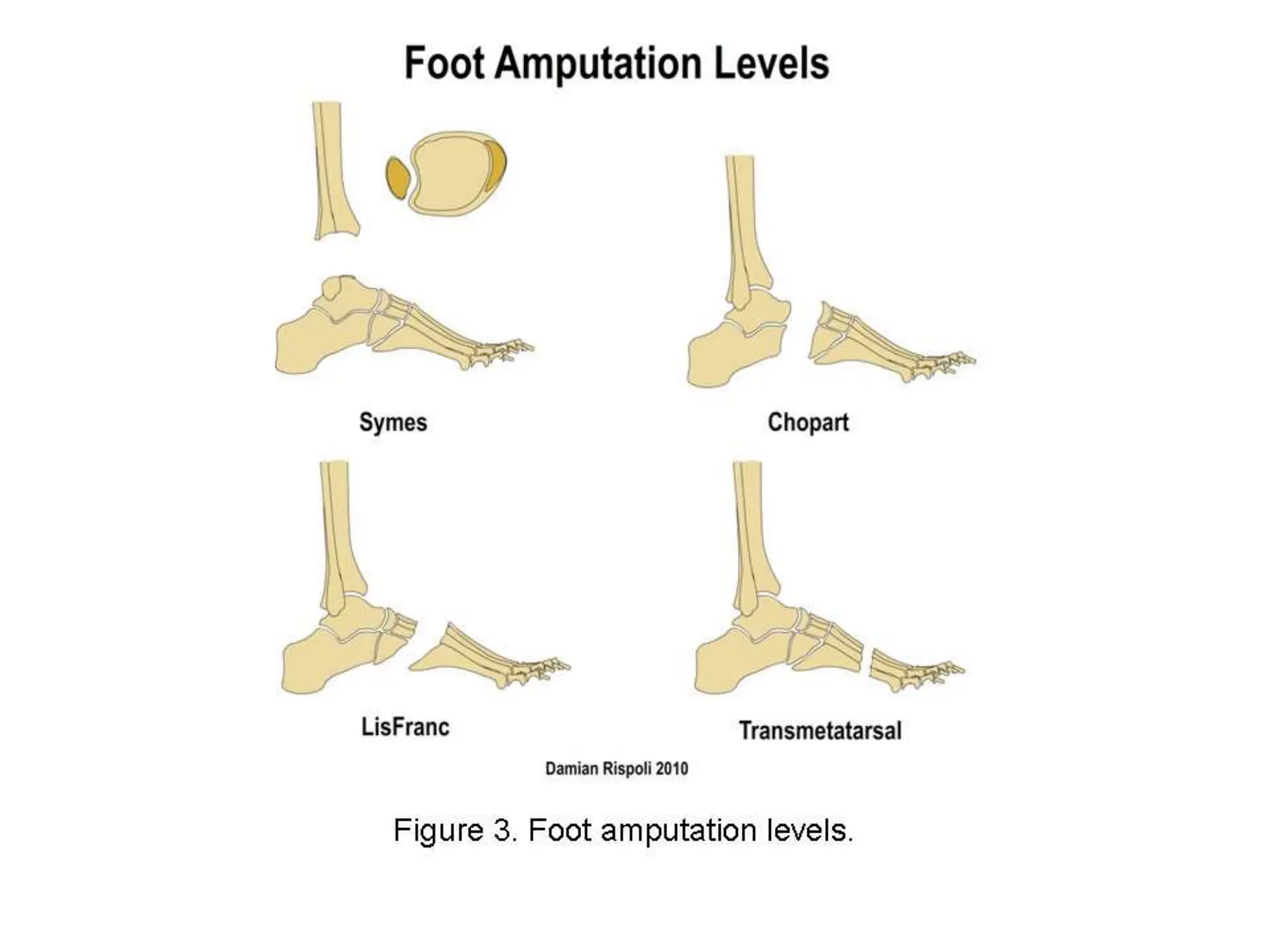 AMPUTATION ppt By Dr. Mumux | PPTX