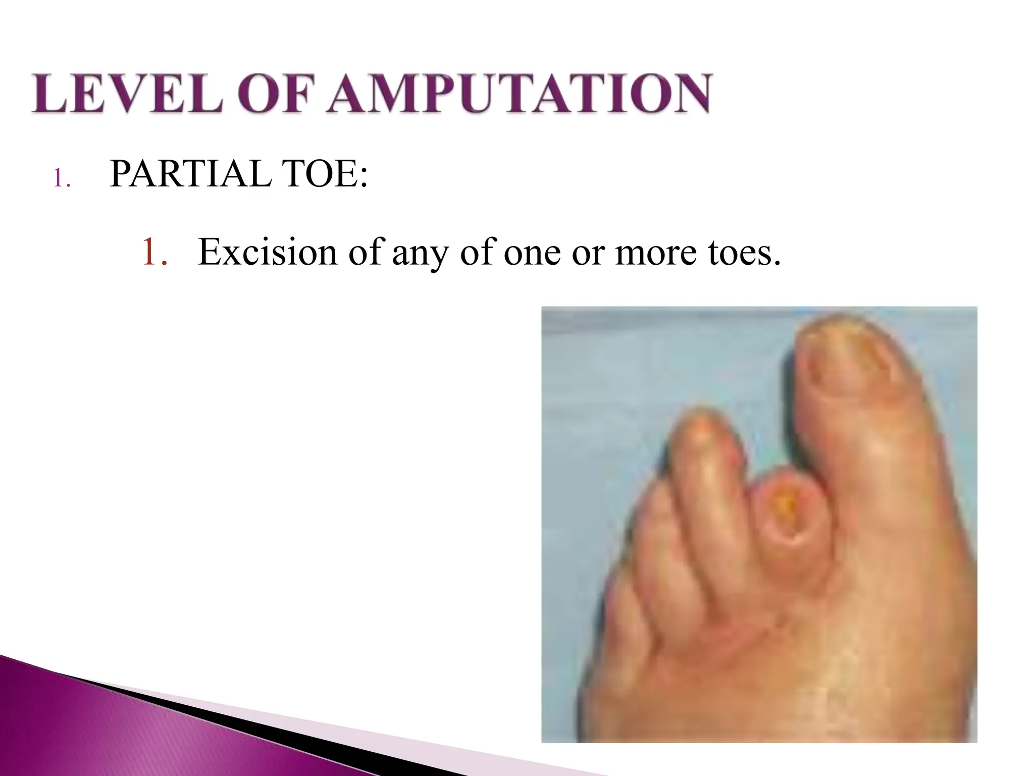 AMPUTATION ppt By Dr. Mumux | PPTX