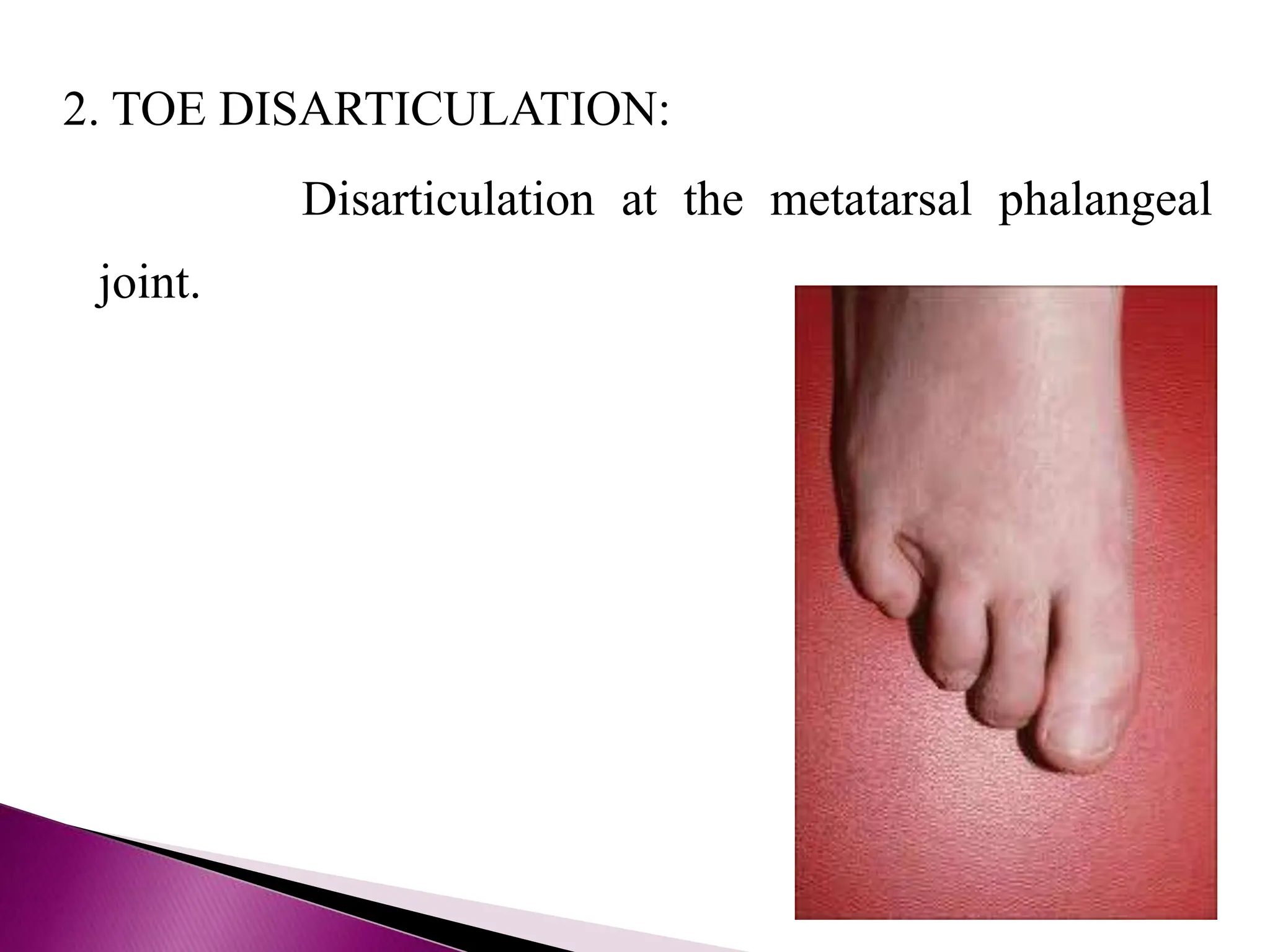 AMPUTATION ppt By Dr. Mumux | PPTX