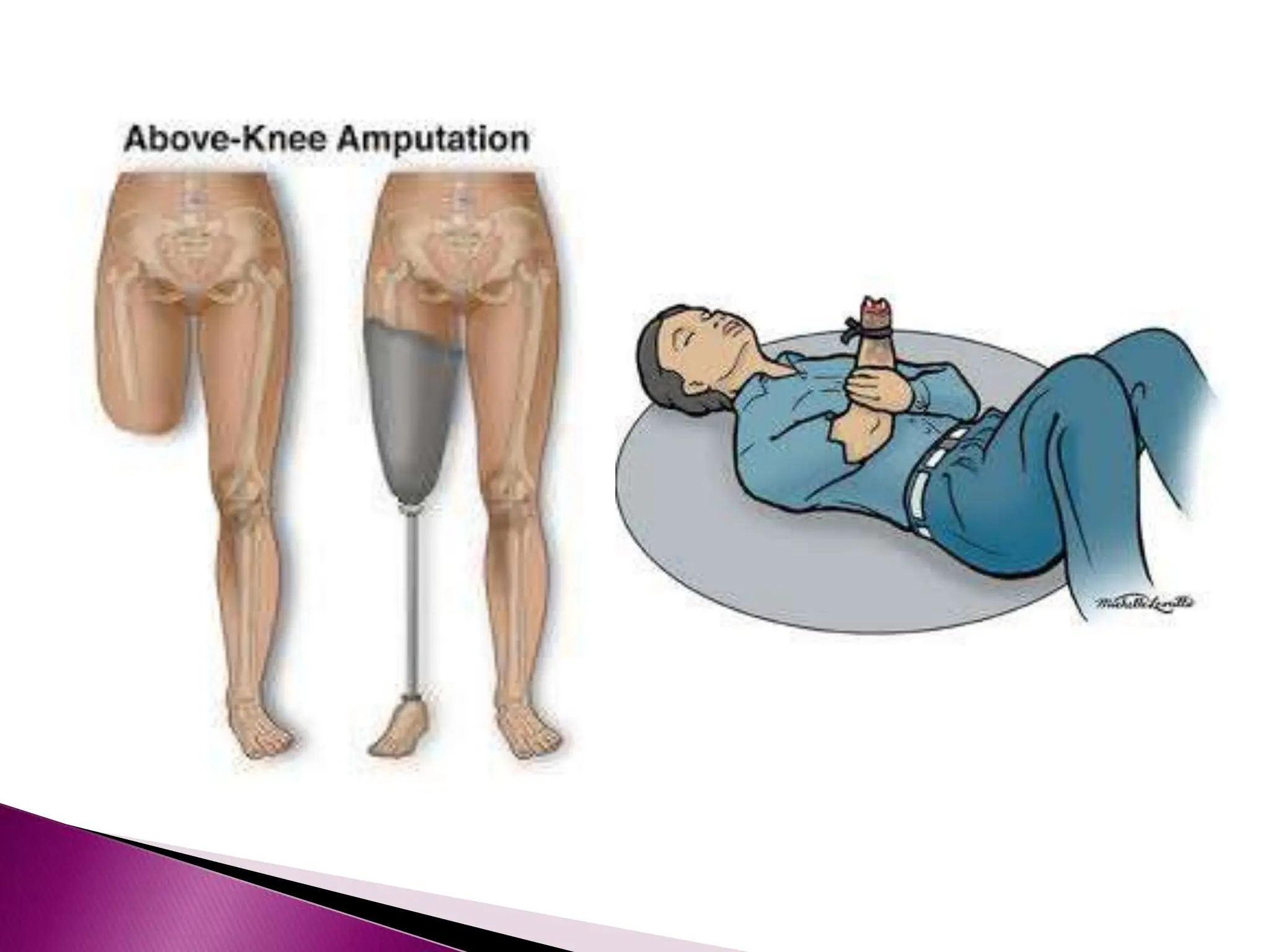 AMPUTATION ppt By Dr. Mumux | PPTX