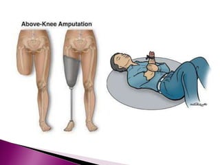 AMPUTATION ppt By Dr. Mumux | PPTX