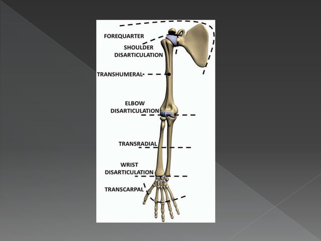AMPUTATION.pdf