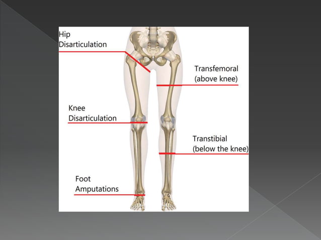 AMPUTATION.pdf