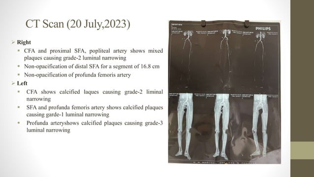 Peripheral Vascular Disease (PVD): Physiotherapy assessment and ...