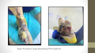 Peripheral Vascular Disease (PVD): Physiotherapy assessment and ...