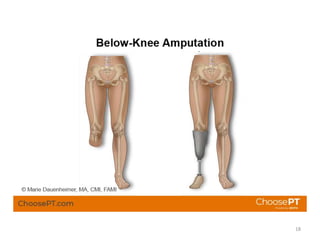 The amputation topic it's discribe all about amputation and procedure ...