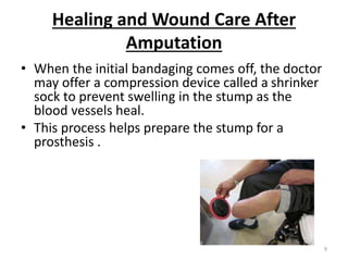 The amputation topic it's discribe all about amputation and procedure ...