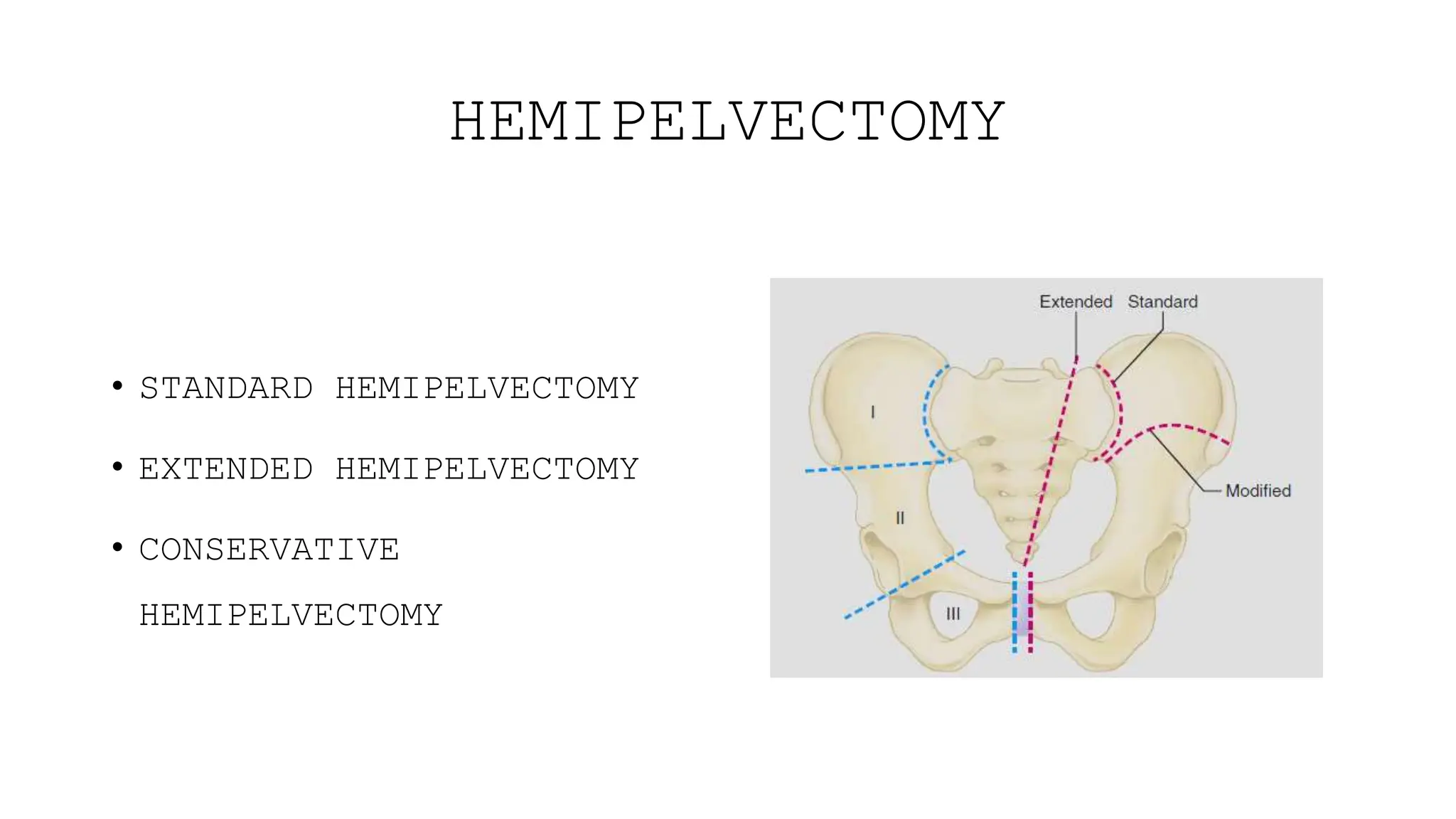 Amputation Topic Orthopaedics Presentation | PPTX