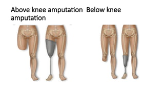 Types of knee,.leg,below kneeAMPUTATION.pptx