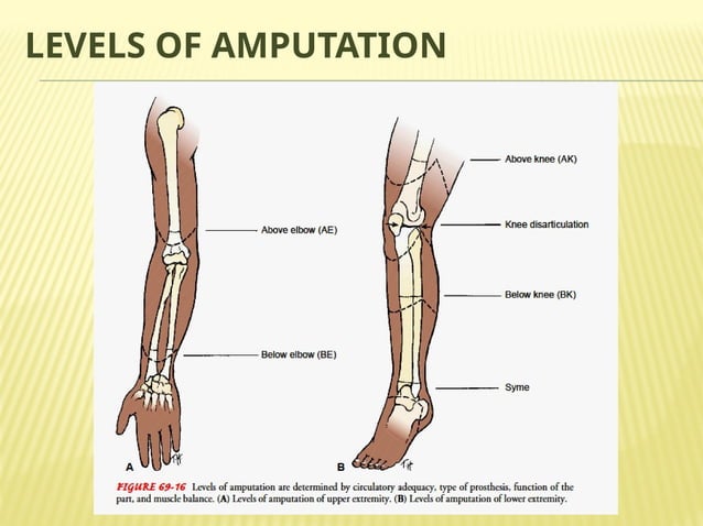 Amputation.pptx slide for nursing students | PPTX
