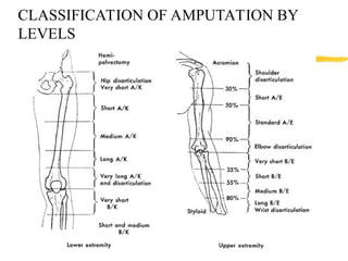 amputation.ppt in crush injury of lowerlimbs | PPT