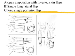 amputation.ppt in crush injury of lowerlimbs | PPT