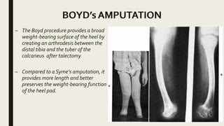 Amputation dr. harsh | PPT