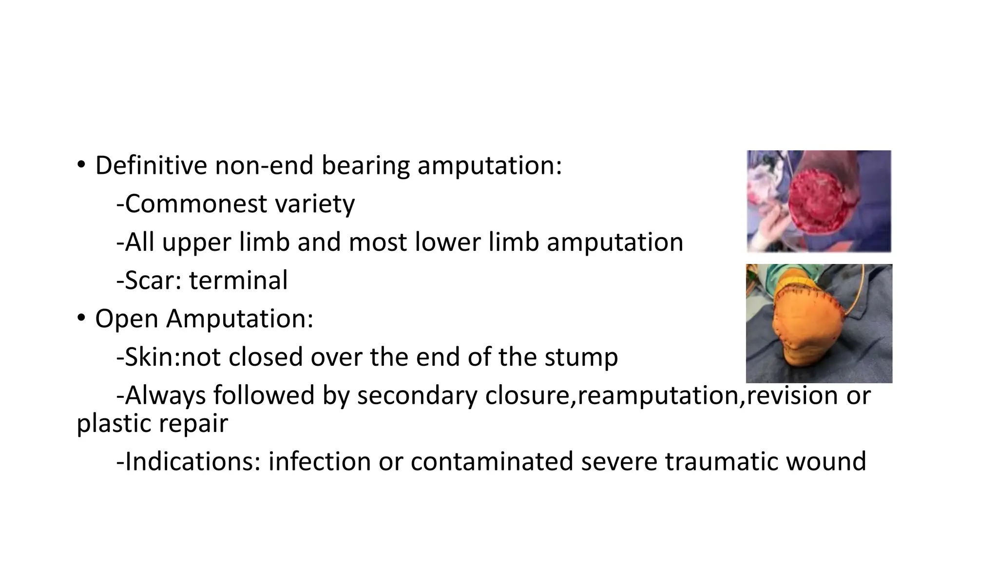 Amputation-Dr.Kushal Khanal 2nd Year .pptx