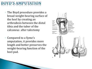 Amputation- Dr. Kiran Kumar G. | PPT