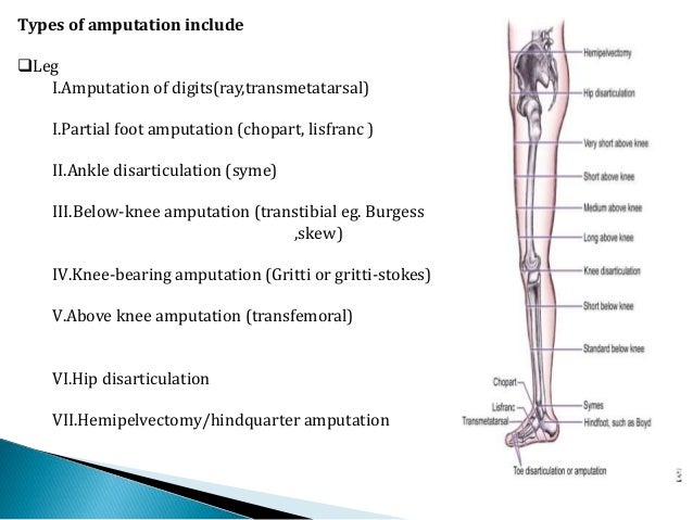 Amputation- Dr. Kiran Kumar G.