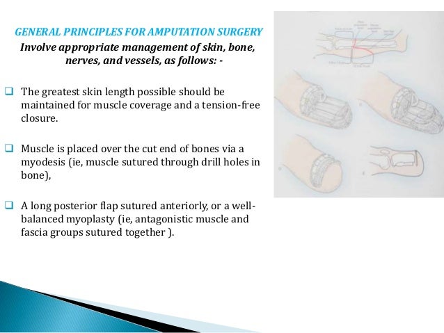 Amputation- Dr. Kiran Kumar G.