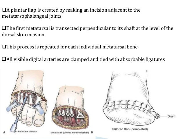 Amputation- Dr. Kiran Kumar G.