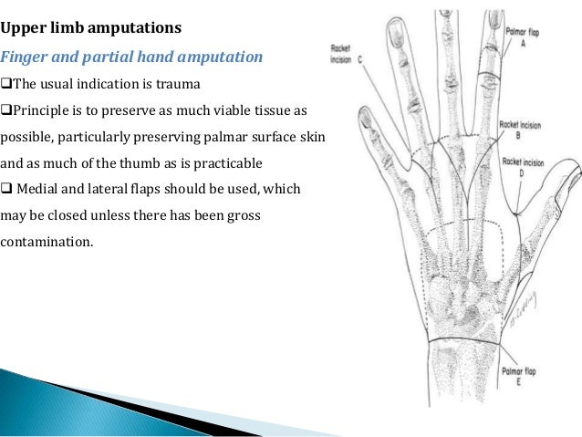 Amputation- Dr. Kiran Kumar G.