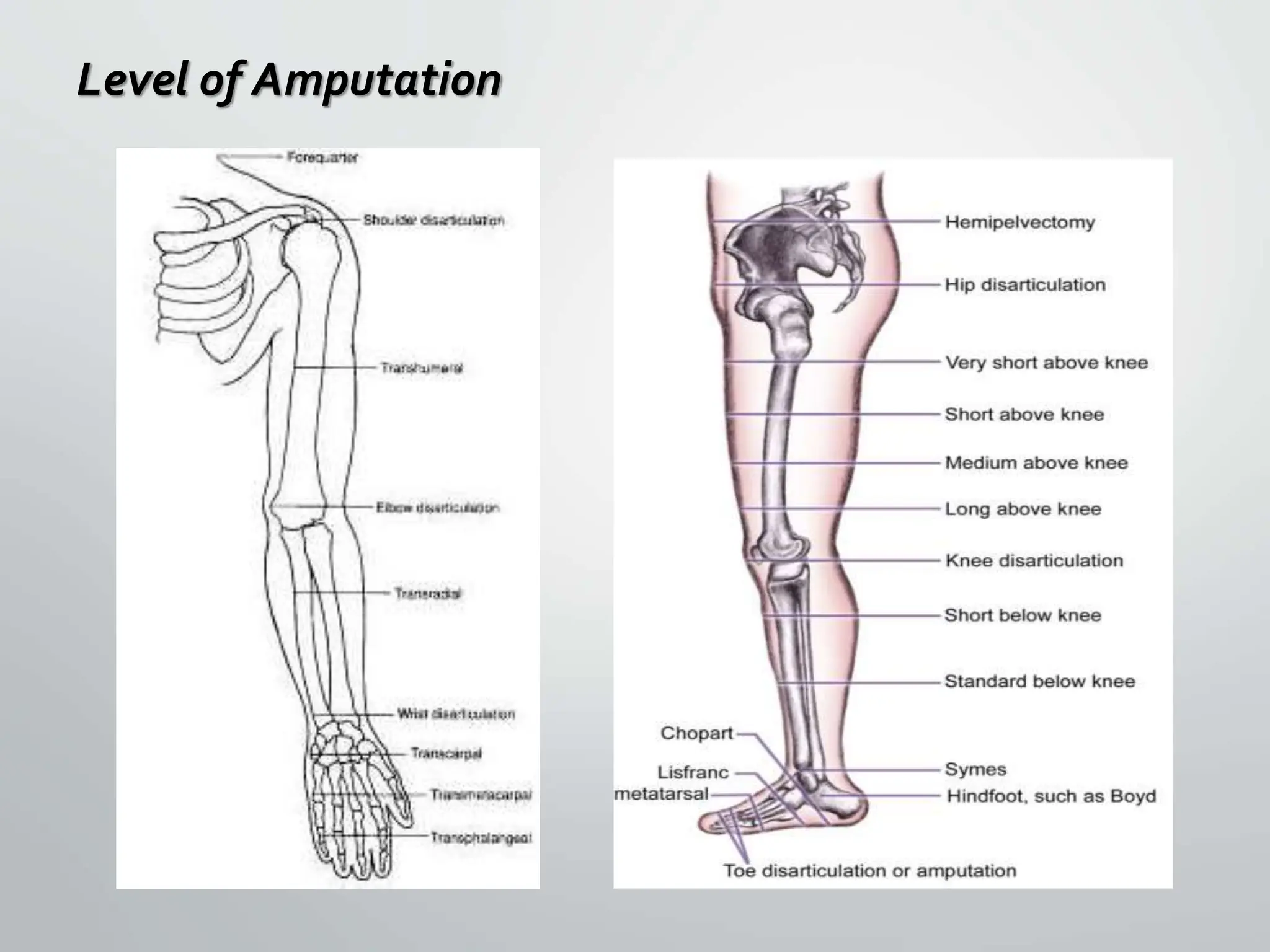 amputation orthopedics mbbs with types.pptx