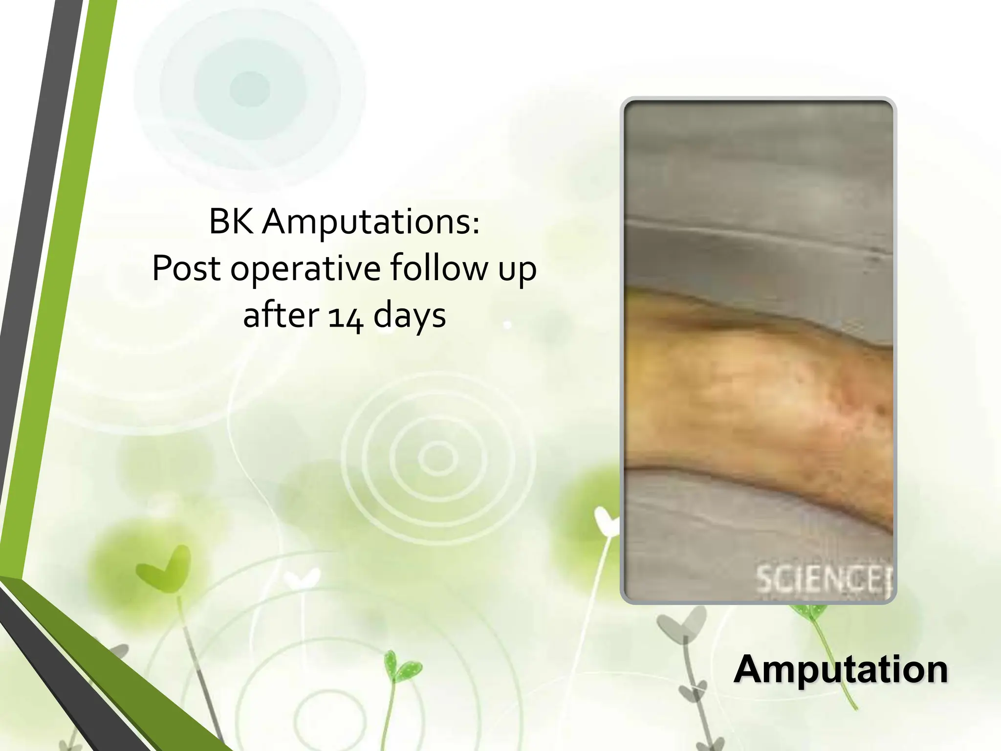 amputation orthopedics mbbs with types.pptx
