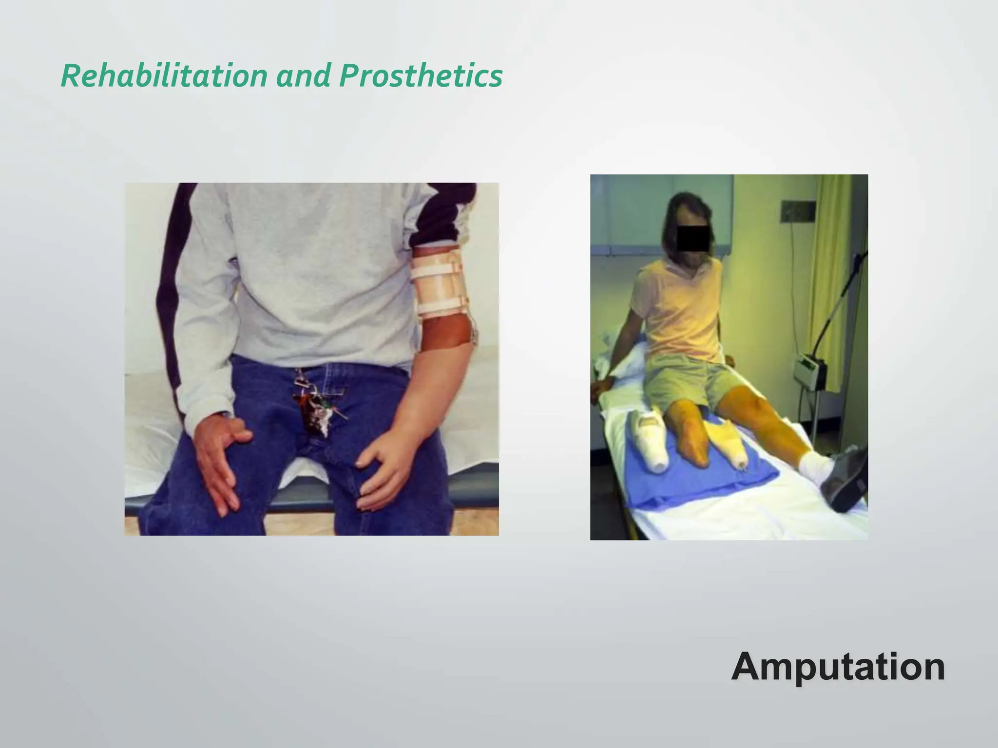 amputation orthopedics mbbs with types.pptx