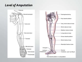 amputation orthopedics mbbs with types.pptx