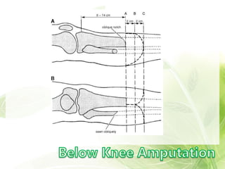 amputation orthopedics mbbs with types.pptx