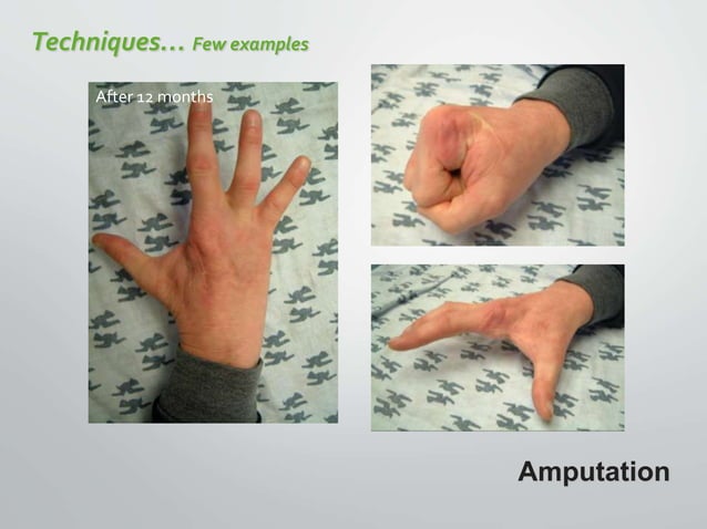 amputation orthopedics mbbs with types.pptx