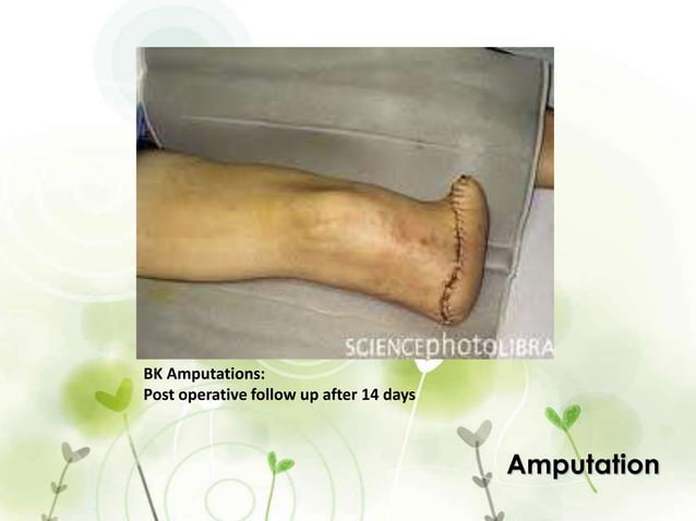 Amputation in Surgery