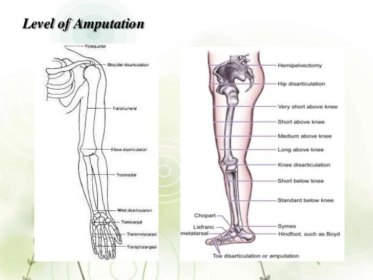 Amputation in Surgery