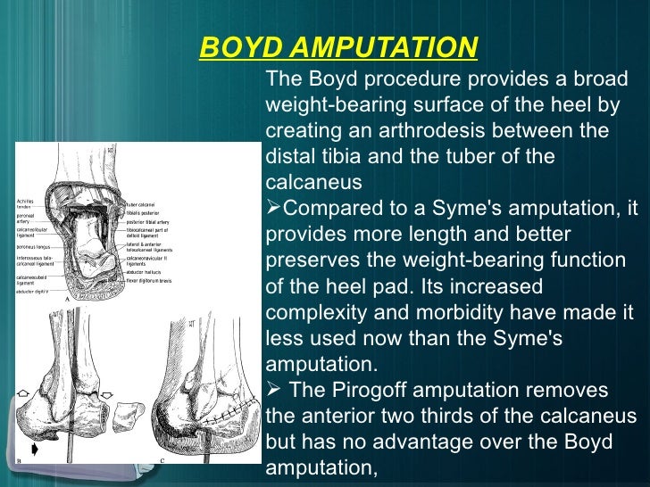 Amputation.Dr Pramod