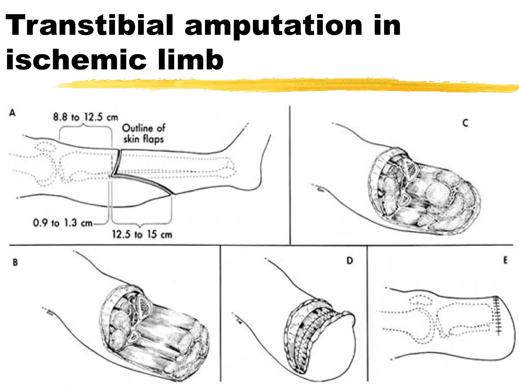 Amputation1.ppt in crush injury of upper and lower | PPT