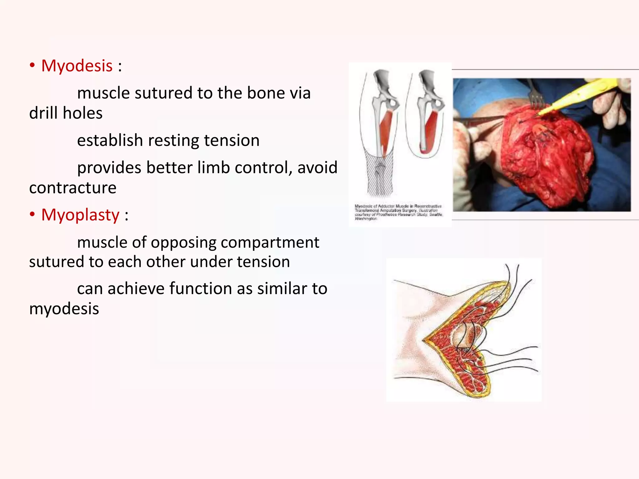 Amputation and disarticulation | PPTX