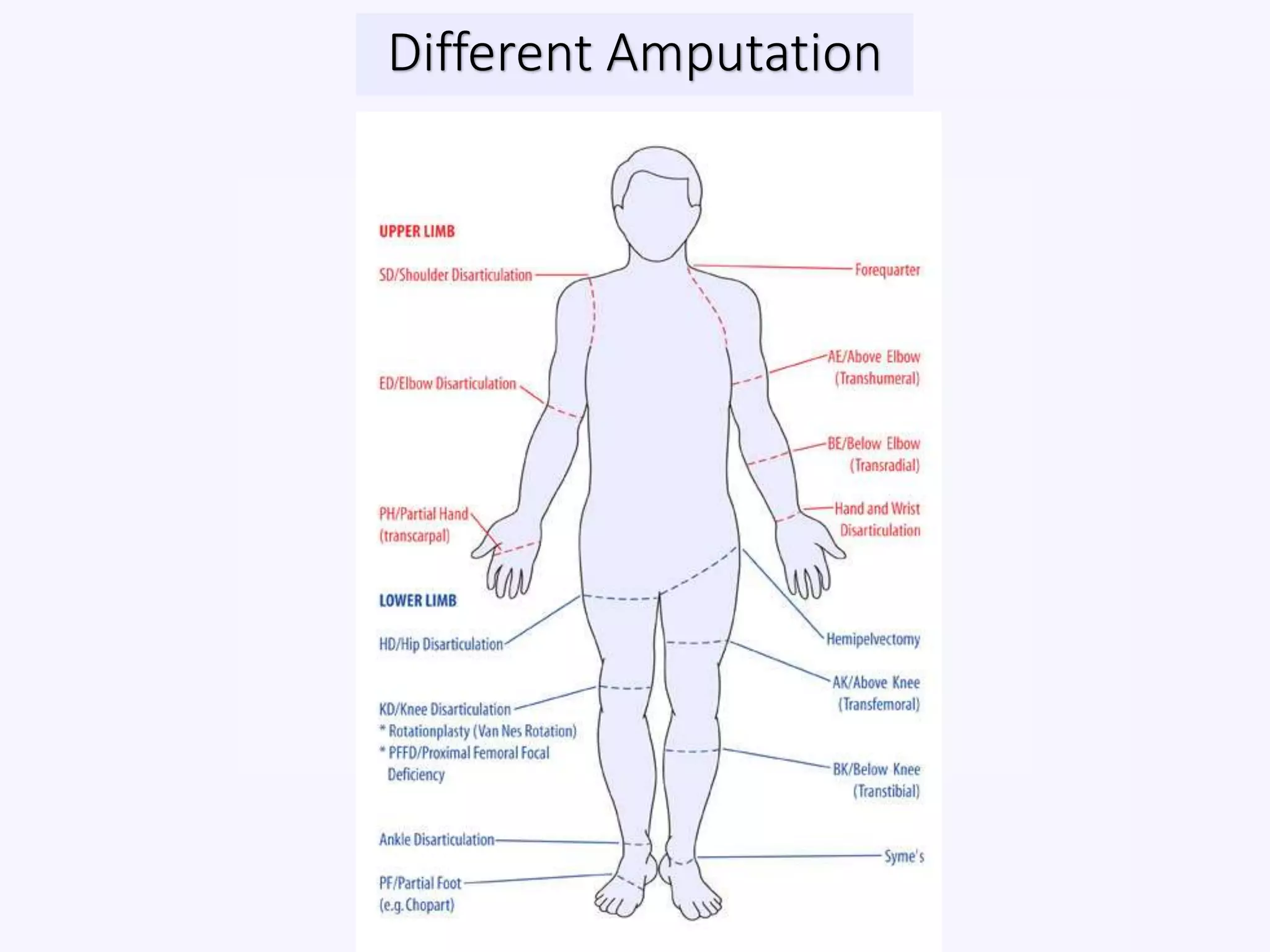 Amputation and disarticulation | PPTX