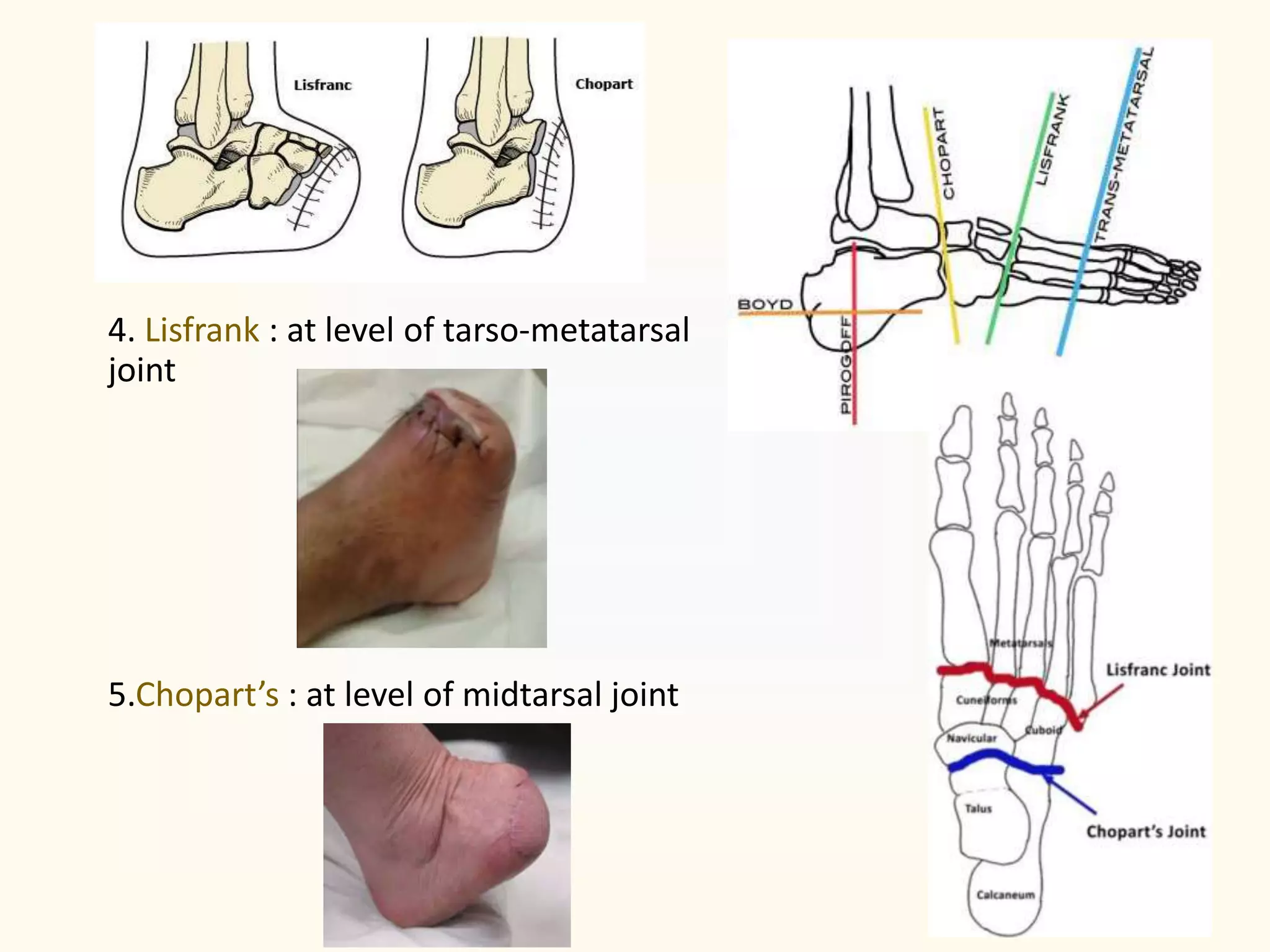 Amputation and disarticulation | PPTX