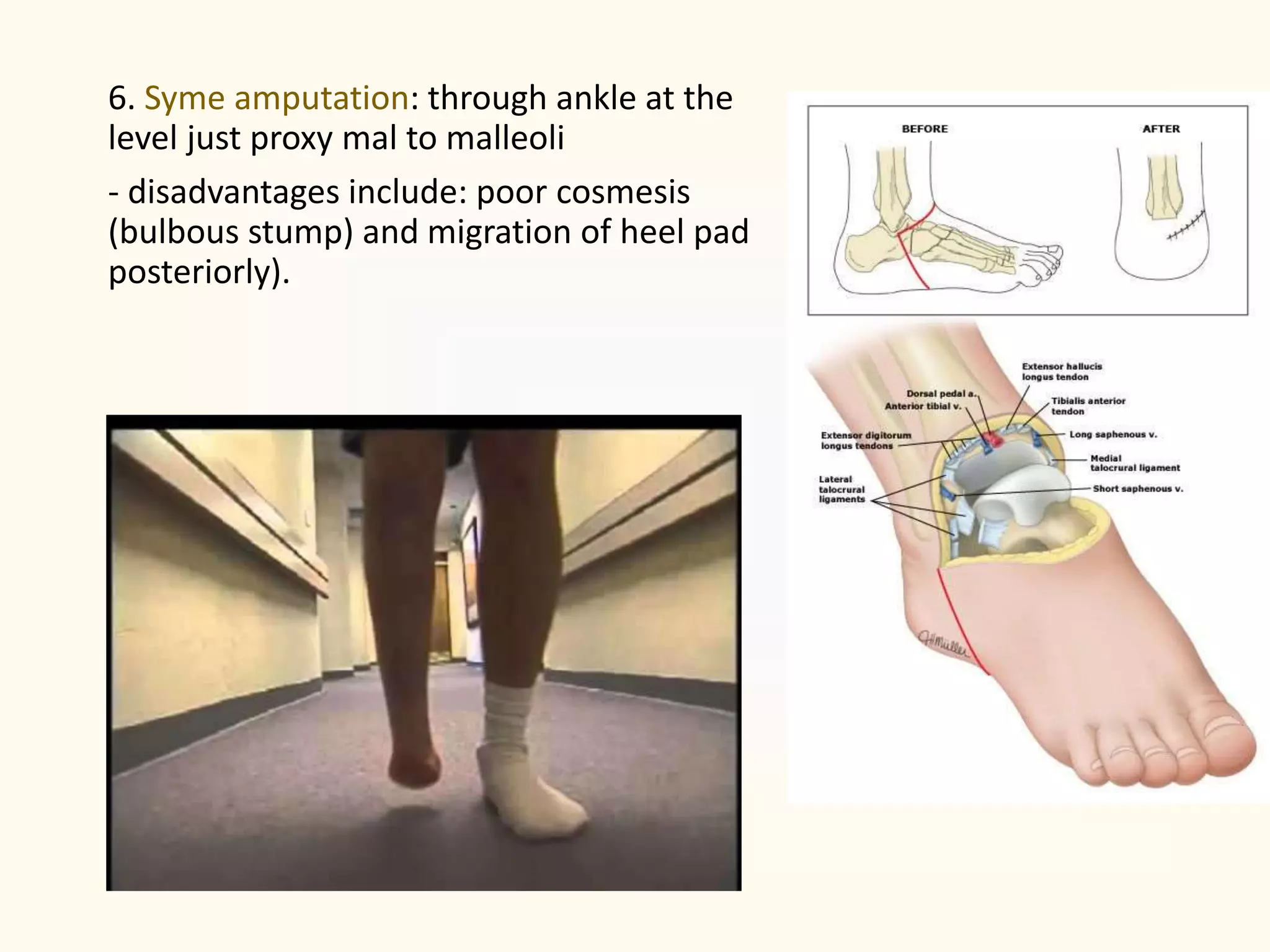 Amputation and disarticulation | PPTX
