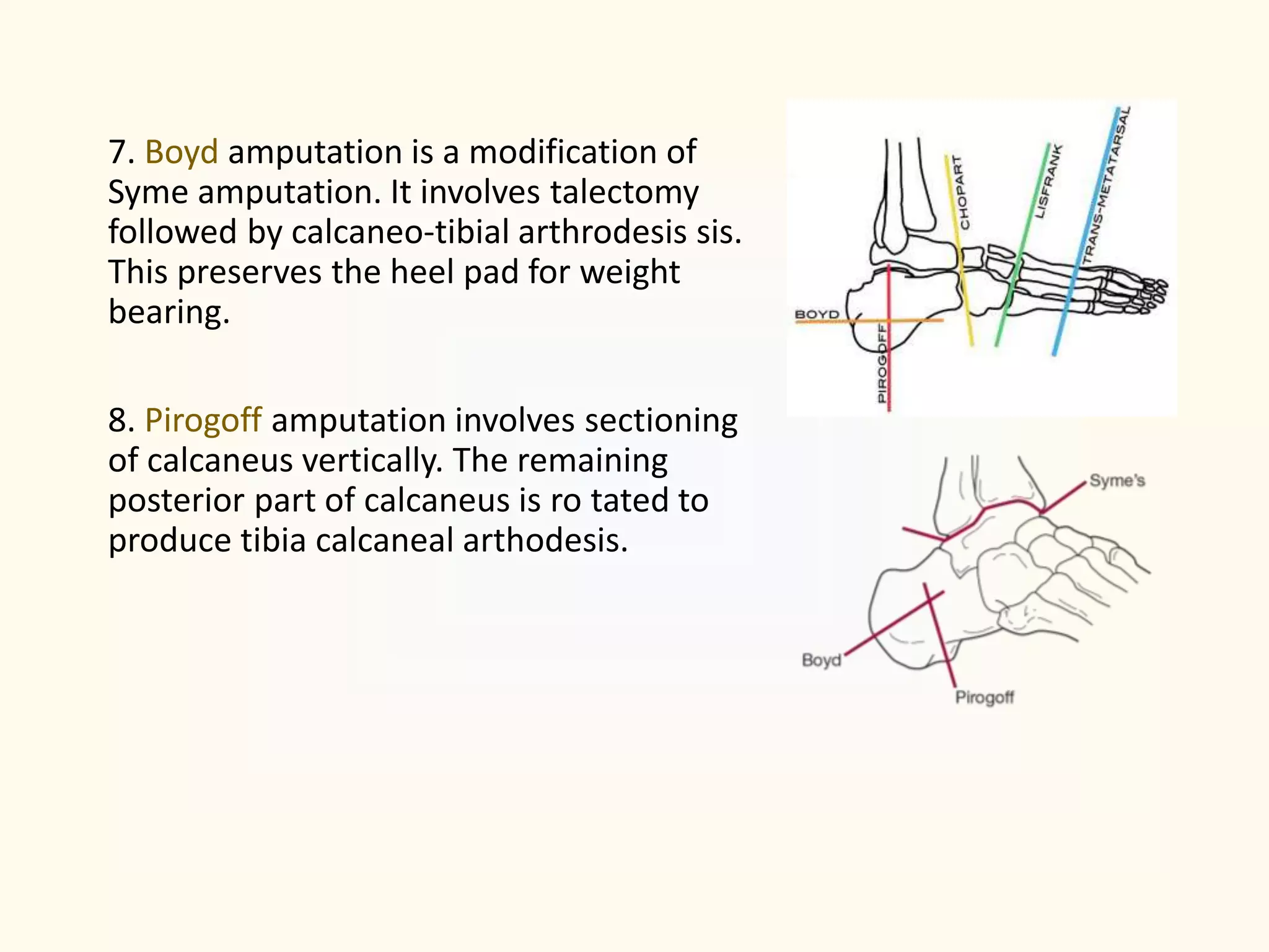 Amputation and disarticulation | PPTX