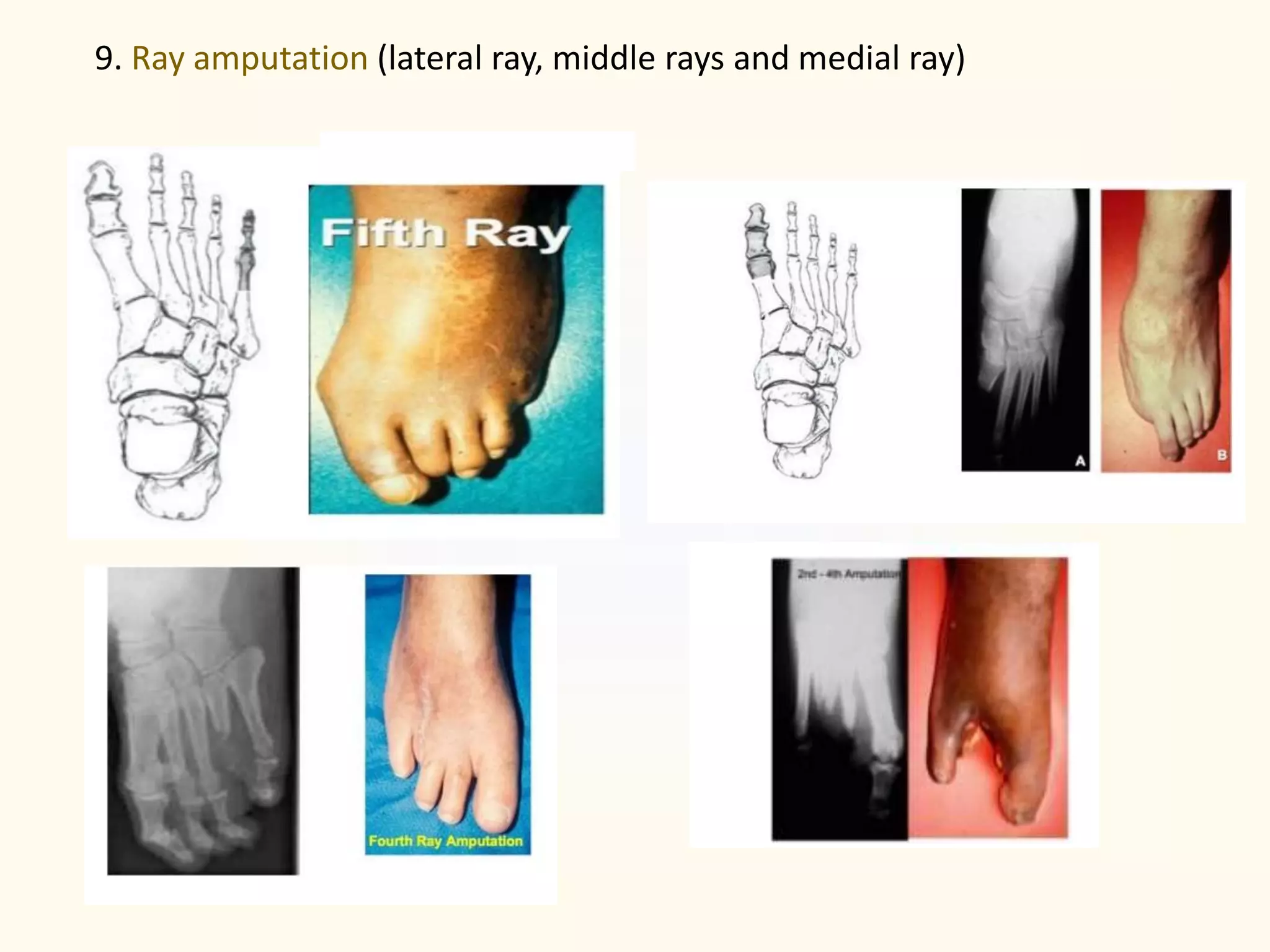 Amputation and disarticulation | PPTX