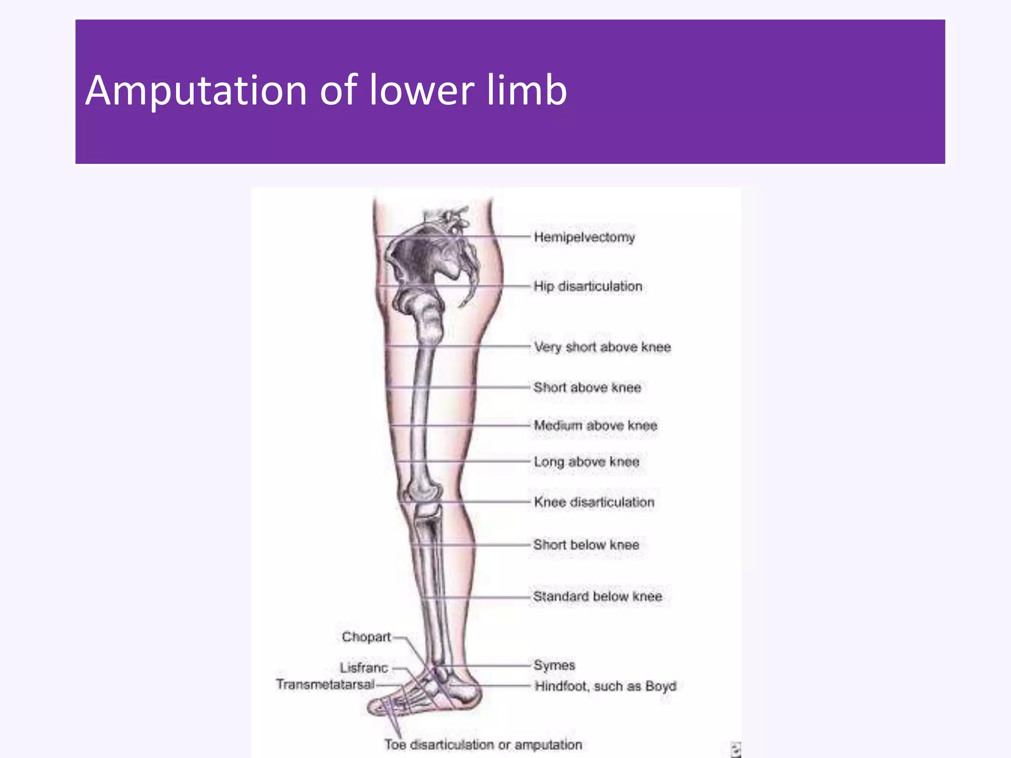 Amputation and disarticulation | PPTX