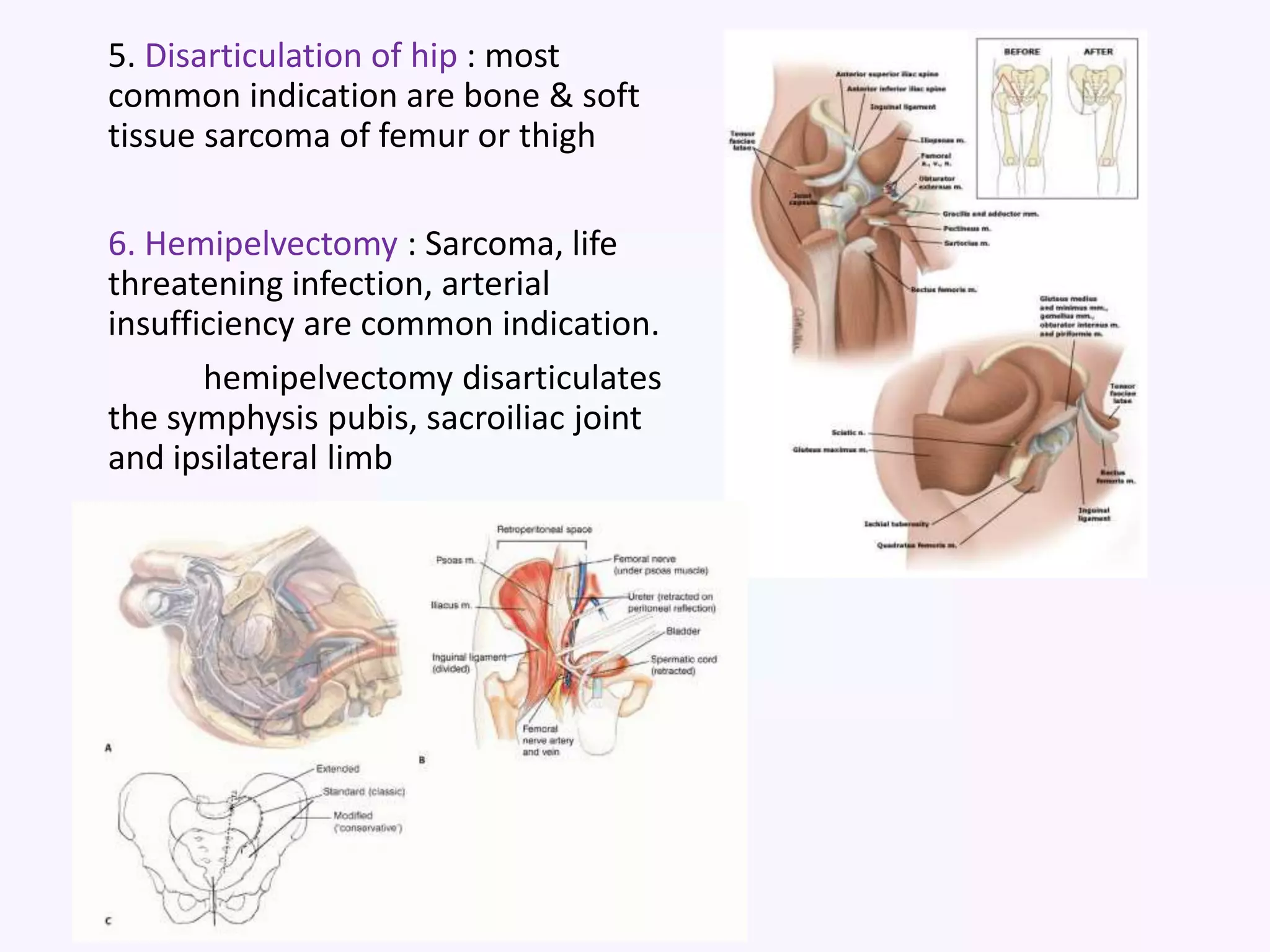 Amputation and disarticulation | PPTX