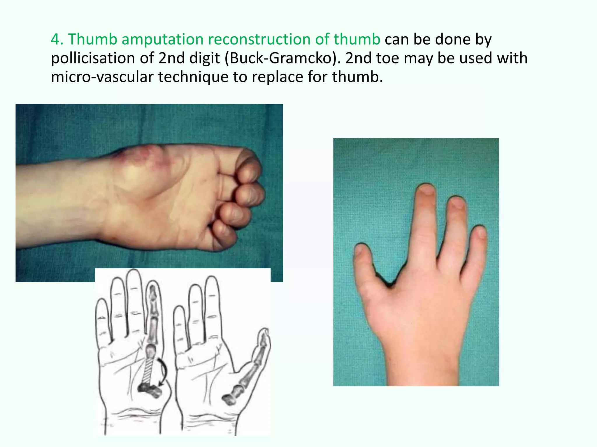 Amputation and disarticulation | PPTX
