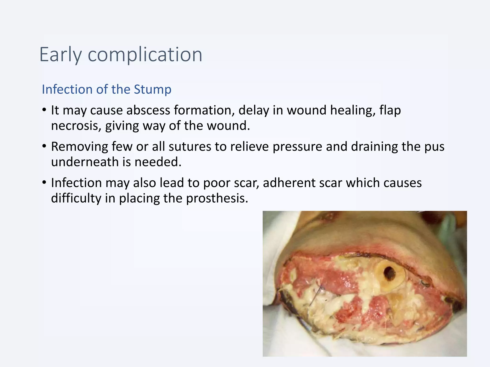 Amputation and disarticulation | PPTX | Death, Injury, or Military ...