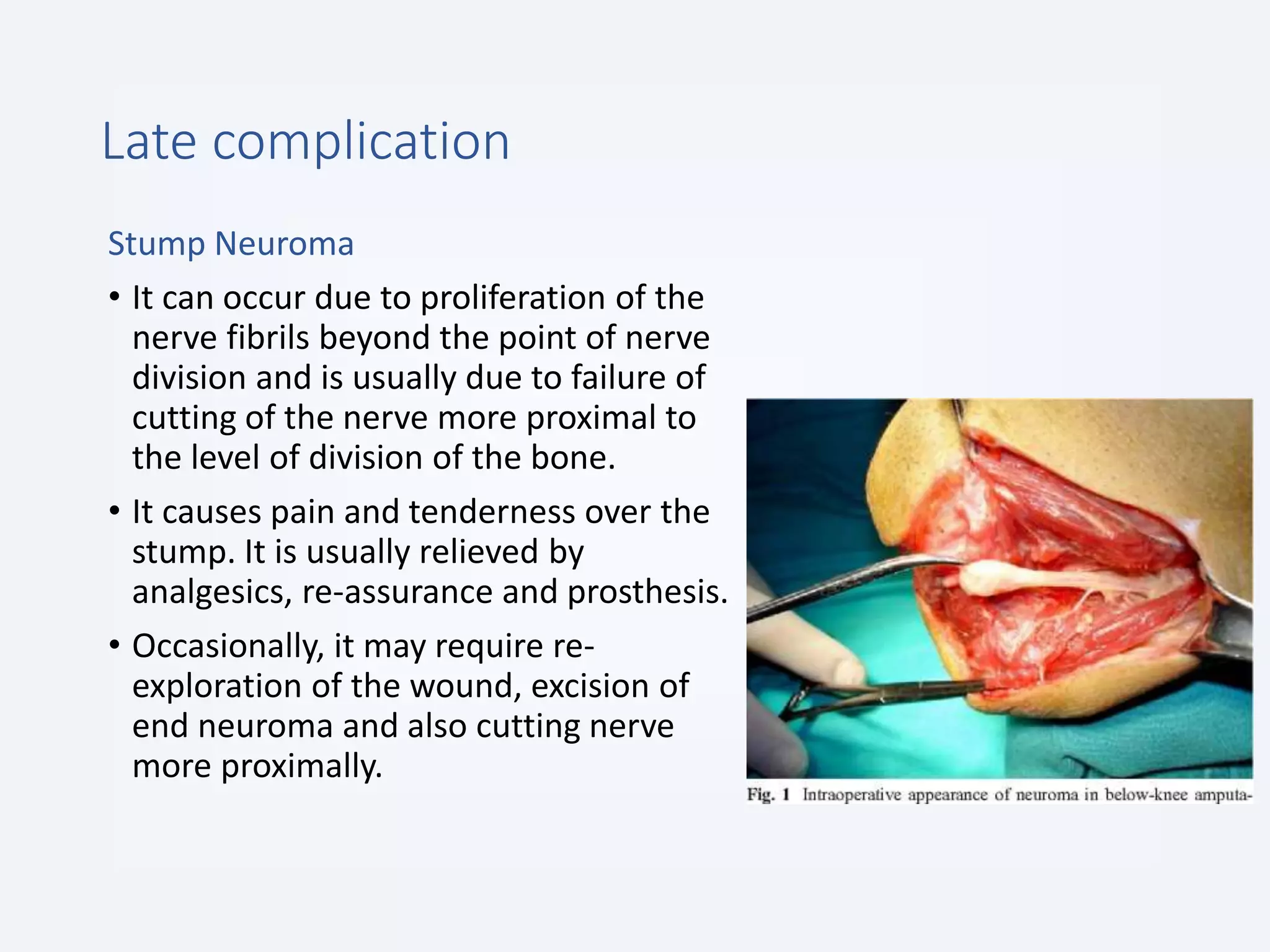 Amputation and disarticulation | PPTX