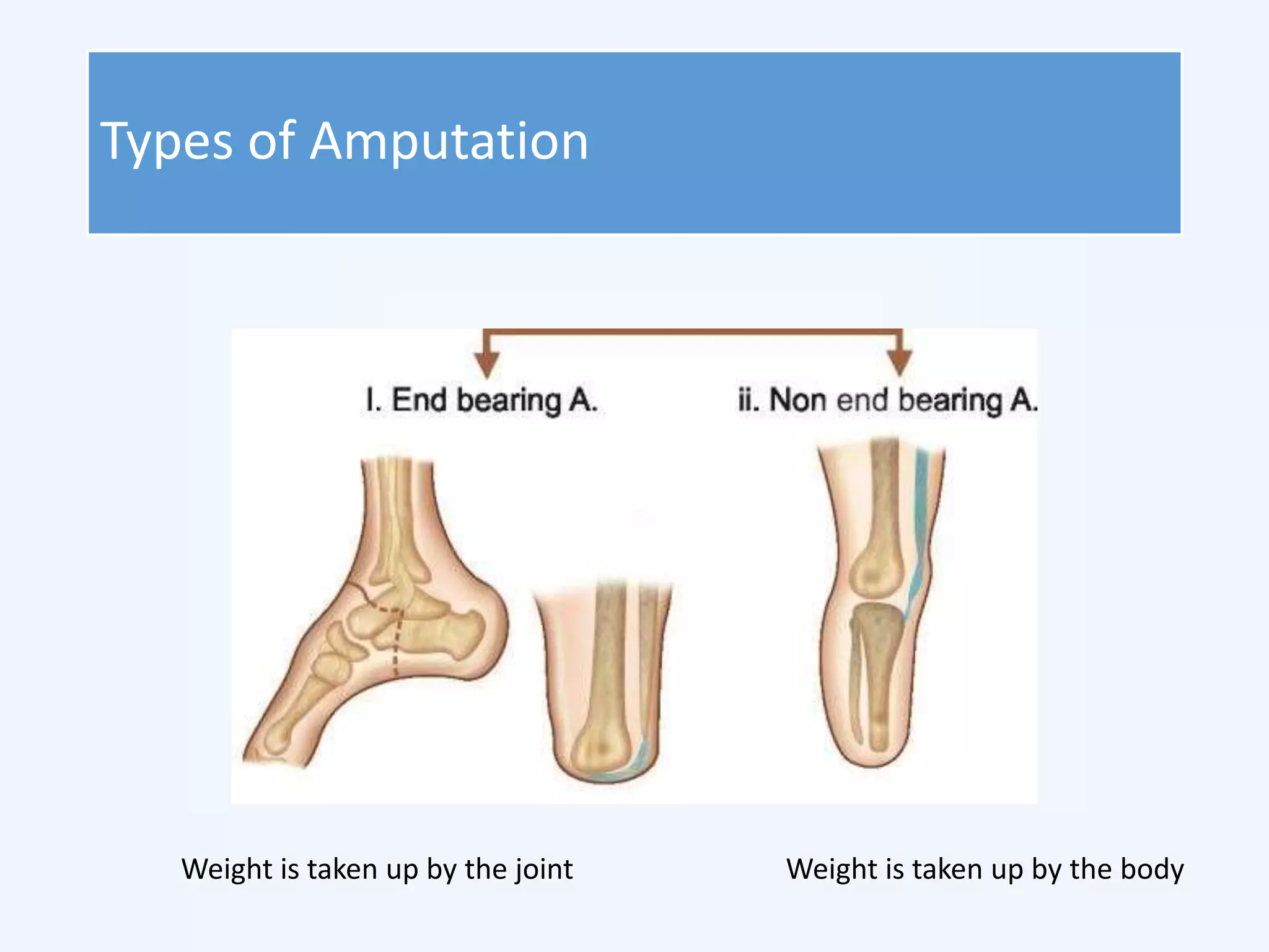 Amputation and disarticulation | PPTX | Death, Injury, or Military ...