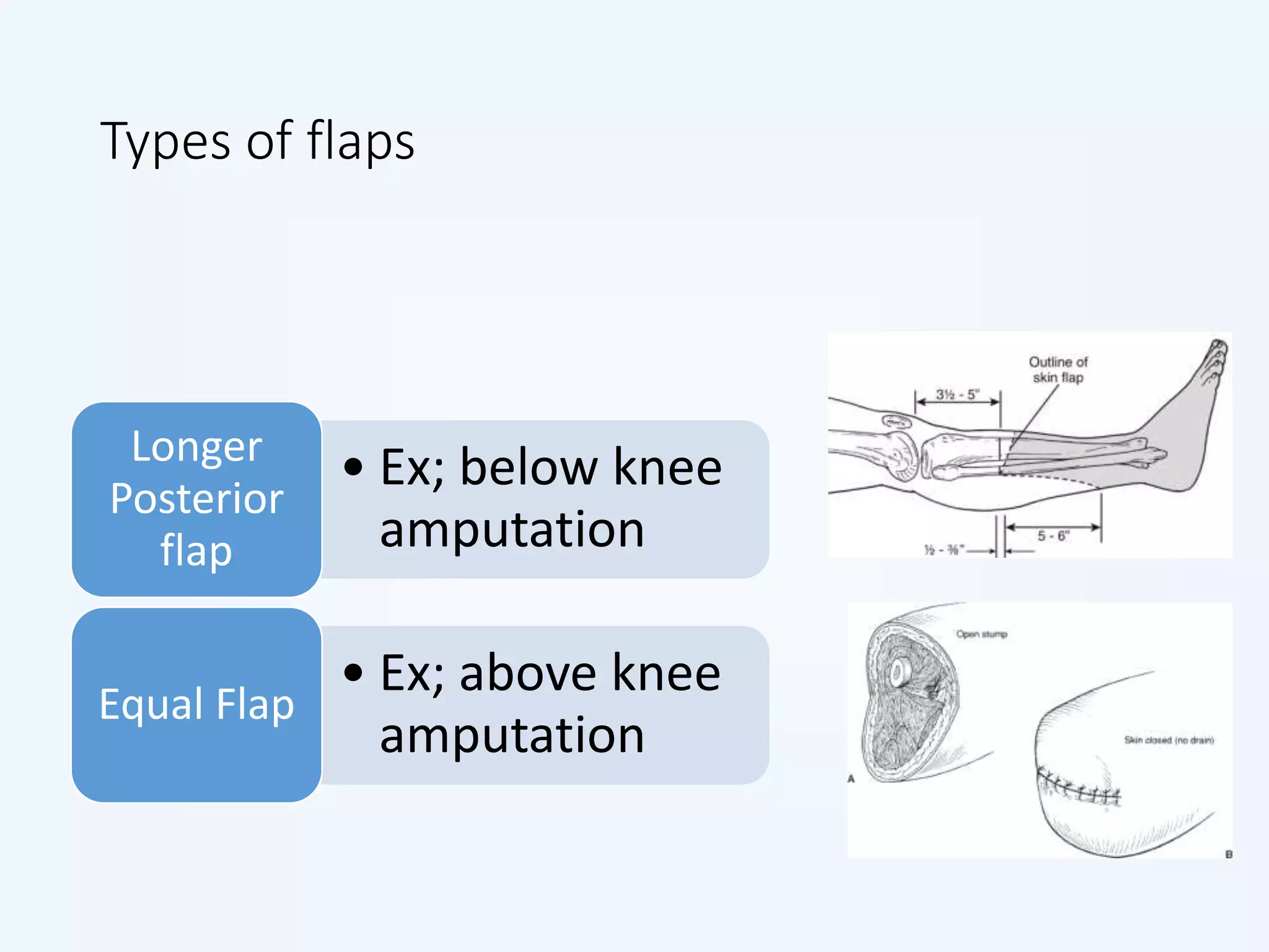 Amputation and disarticulation | PPTX