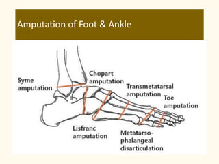 Amputation and disarticulation | PPTX