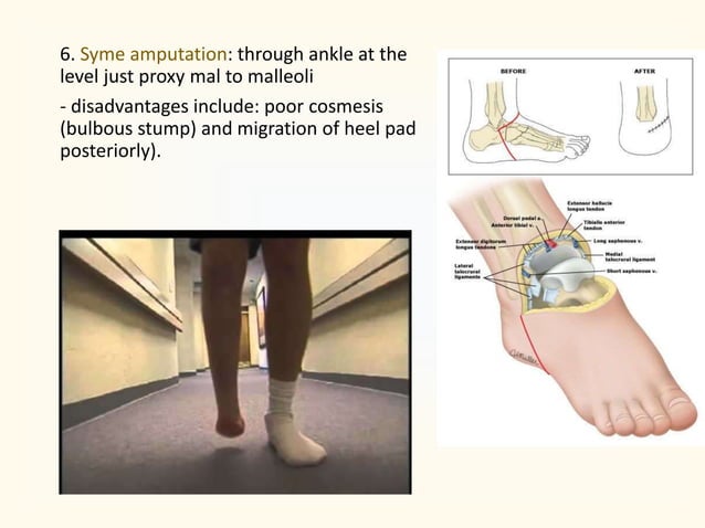 Amputation and disarticulation | PPTX | Death, Injury, or Military ...