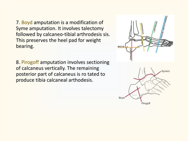 Amputation and disarticulation | PPTX | Death, Injury, or Military ...